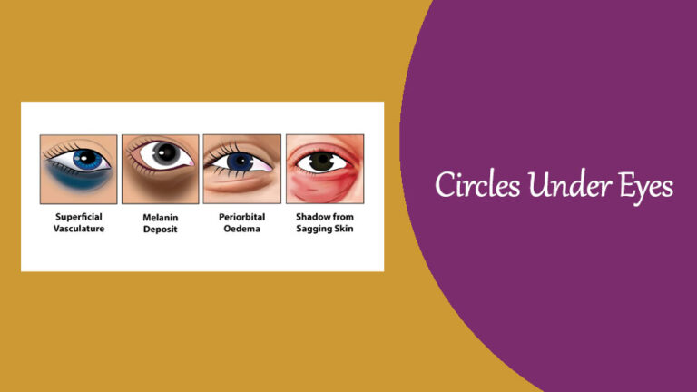 Circles Under Eyes: Causes and Treatments - AgromedBotanic