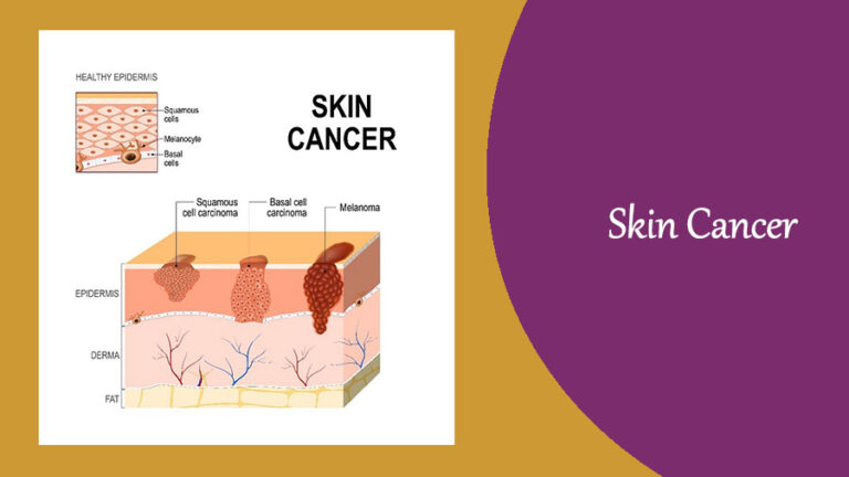 Skin Cancer: A Comprehensive Guide to Types and Symptoms